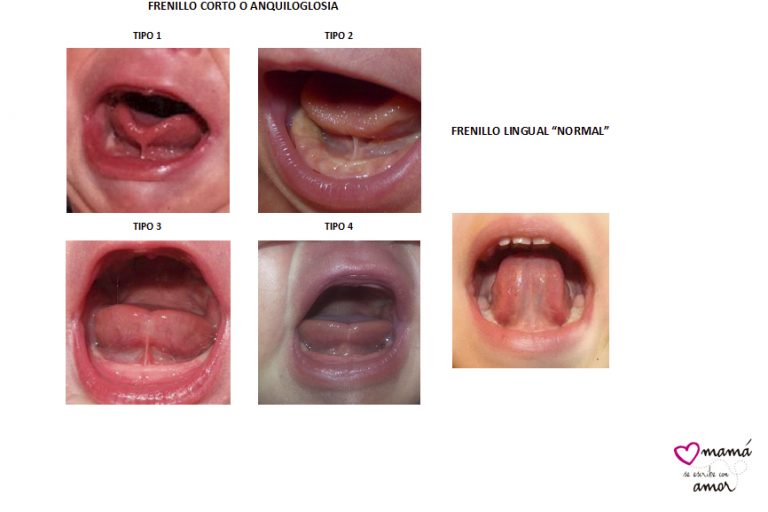 Frenillo corto o anquiloglosia | Mamá se escribe con amor